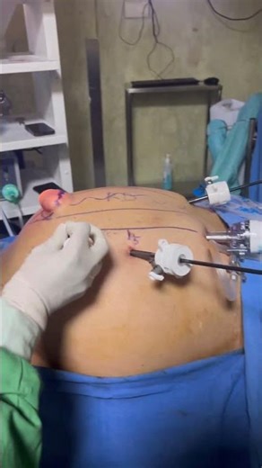 Your Hernia Deserves a Keyhole, Not a Knife 🔑✂️ #dranshumankaushal