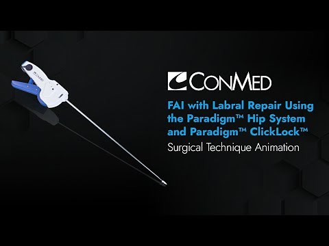 FAI with Labral Repair Using the Paradigm™ System and Paradigm™ ClickLok™ - CONMED Technique