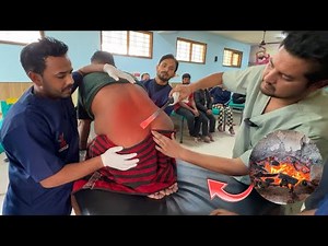 “Agnikarma Treatment LIVE 🔥 Lower Back Pain Ka Asli Ayurvedic Ilaaj’’