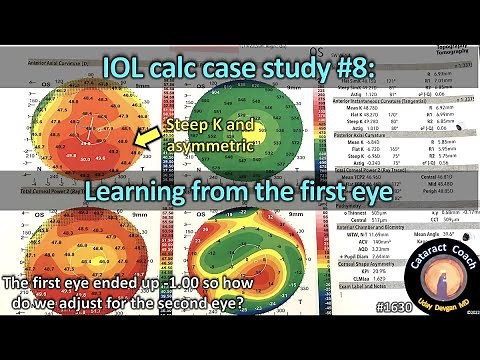 CataractCoach 1630: IOL calc case study 8: learning from first eye