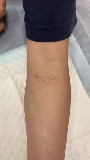 Fine Line Tattoo Laser Removal - Swift Tattoo Removal Melbourne