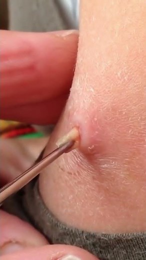 Botfly Maggot Removal Satisfaction Video #shorts