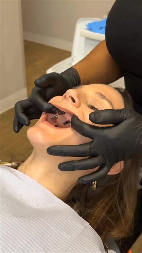 My 90 Day Dental Implants Journey and Exciting Next Steps