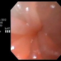 Video: Flexible Colonoscopy in Mice to Evaluate the Severity of Colitis and Colorectal Tumors Using a Validated Endoscopic Scoring System