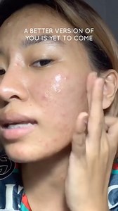 53K views · 76 reactions | Overcoming pimples is a journey we all...