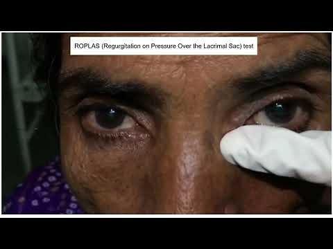 ROPLAS (Regurgitation on pressure over the lacrimal sac) test | ENT Lecture Series