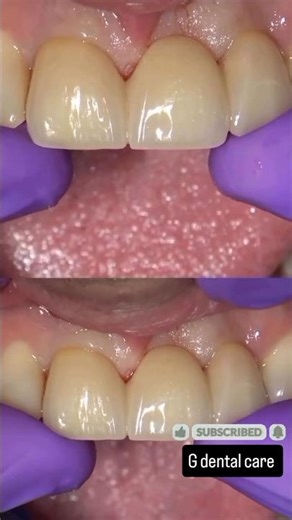 #dental #dentist #dentalclinic #viral #shortvideo #teethclinic capping # gdentalcare