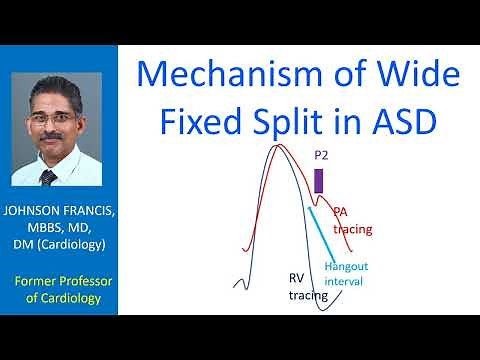 Mechanism of Wide Fixed Split in ASD