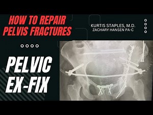 POV: Pelvic External Fixator Step-by-Step | Ortho Trauma Surgery with Dr. Kurtis Staples