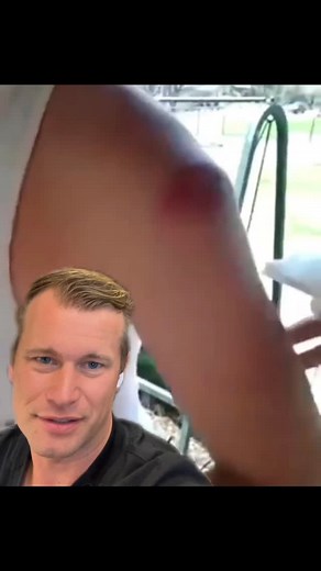 Austin Lee, PA-C | Medical and Cosmetic Dermatology on Instagram: "Massive infected abscess on the arm! #infection #bacteria #fyp #pimple #cyst"