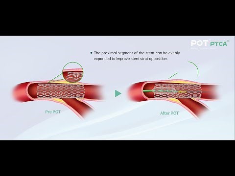 BrosMed POT PTCA Balloon Dilatation Catheter
