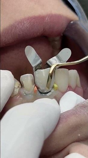 Composite veneer for anterior teeth after removal of old restorations #dentist