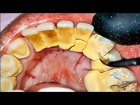 Tartar/Calculus Removal Back of teeth #dentalcare #plaque #teethcleaning