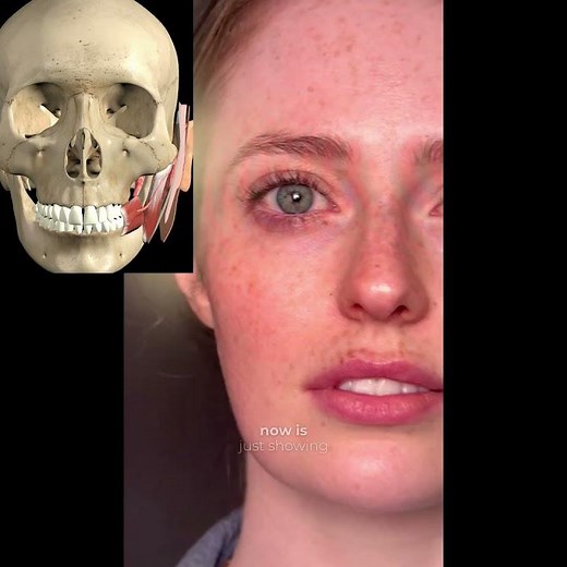 Masseter reduction simulation