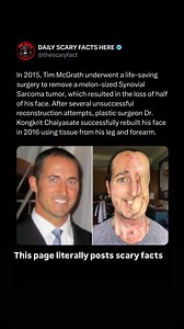 In 2015, Tim McGrath was diagnosed with a melon-sized Synovial Sarcoma tumor, a rare and aggressive form of cancer. To save his life, doctors performed a surgery to remove the tumor, but the procedure resulted in the loss of half of his face, including parts of his jaw, cheek, and eye socket. Despite multiple attempts at reconstructing his face, the results were unsuccessful. In 2016, renowned plastic surgeon Dr. Kongkrit Chaiyasate stepped in to help. Dr. Chaiyasate performed a complex procedur