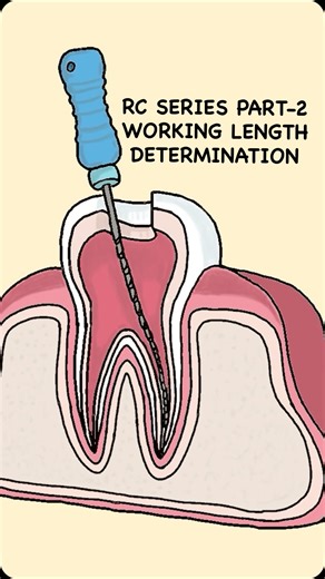 Preeti Saini on Instagram: "🦷ROOT CANAL SERIES PART-2 ✅WORKING LENGTH DETERMINATION ... ✅ARMAMENTARIUM... ✨Pre-operative Radiograph ✨Glide path files (8 K or 10 K) ✨15-K files ✨Scale ✨Endo Gauge ✅IMPORTANT POINTS.. ✨Straight line access to be established ✨Fixed reference point (incisal edge for anteriors and buccal cusps for posteriors) ✨Remove carious, defective or weakend tooth structure to have solid reference point. ✅STEPS... ✨Measure the tooth on the preoperative radiograph. ✨Subtract at l