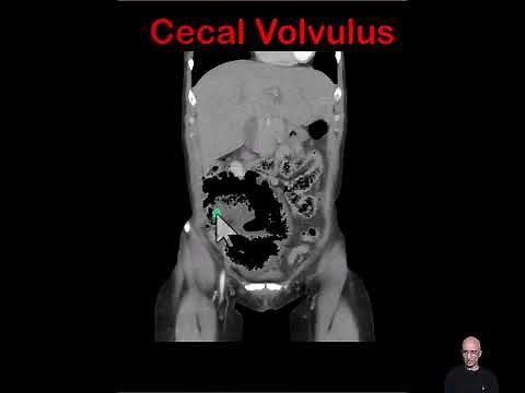 Cecal Volvulus