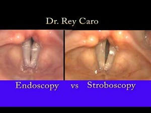 Video Stroboscopy of the Vocal Cords (Dr. Rey Caro)