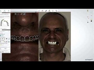 Part 2: 3Shape dental system and TRIOS Smile design: step by step