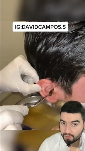 THIS IS HOW EAR WASHING IS DONE