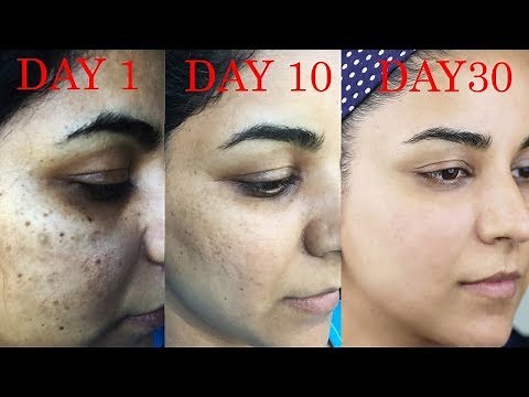 How I Got Rid of Dark Scars, Hyperpigmentation, Pimples/Acne