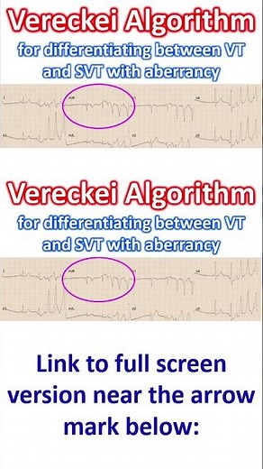 Vereckei Algorithm for differentiating between VT and SVT with aberrancy