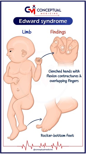 Conceptual Medicine on Instagram: "🧬 Trisomy 18 (Edwards Syndrome) 🔹 Karyotype ♀ 47,XX,+18 ♂ 47,XY,+18 🔹 Core Clinical Features 👂 Low-set ears (malformed auricle) 👶 Micrognathia 🧠 Prominent occiput ✊ Clenched fists with overlapping fingers 🦶 Rocker-bottom feet ❤️ Congenital heart defects – VSD, ASD, Tetralogy of Fallot 🔹 Diagnosis (Quadruple Test) ⬇️ AFP ⬇️ β-hCG ⬇️ Free estriol ➖ / ⬇️ Inhibin A 🔹 Prognosis ⚠️ Very poor ⏳ Only ~13% survive beyond 1 year 🔹 Mnemonic – “PRINCE EDWARD turn