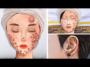 ASMR Collection Squeezing Blackheads, Pustules & Inflamed on the face - Pimple squeezing animation