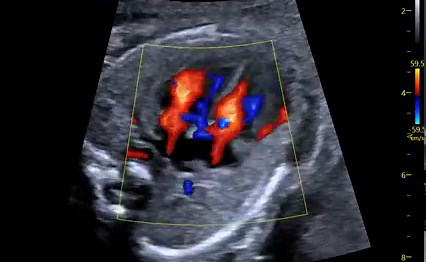 92 reactions · 13 shares | This video is from #Vinno #G86 and the doctor uses the S1-8C probe. This baby‘s heart is about 24 weeks old. When the doctor scans the standard four-chamber heart slice, he adds Vluminous flow features to the 2D model. So we can see the blood flow direction of each heart clearly and dynamically. That would help doctors diagnose #congenitalheartdisease before the baby is born. #VINNOUltrasound #VINNOG86 #Ultrasound | VINNO Ultrasound | Facebook