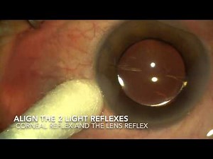 Slit lamp corneal marking for a toric lens