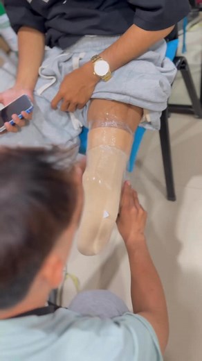 Achieving the Perfect Prosthetic Fit Through 3D Scanning Technology At Instalimb, we utilize advanced 3D scanning technology to design each prosthetic socket with precision. This ensures a personalized fit that promotes optimal comfort, improved mobility, and long-term durability. Preparation – The residual limb is carefully wrapped to create a smooth and accurate surface for scanning. Marking – Key anatomical and pressure points are identified to guide the design. 3D Scanning – A high-resolutio