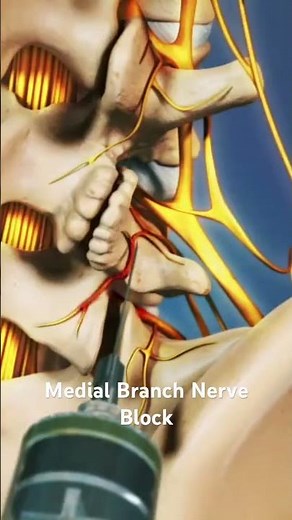 Medial Branch Nerve Block Procedure | Cedar Rapids Pain Associates