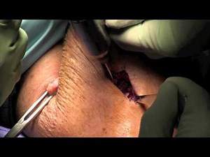 Distal Biceps Allograft Reconstruction • Video • MEDtube.net