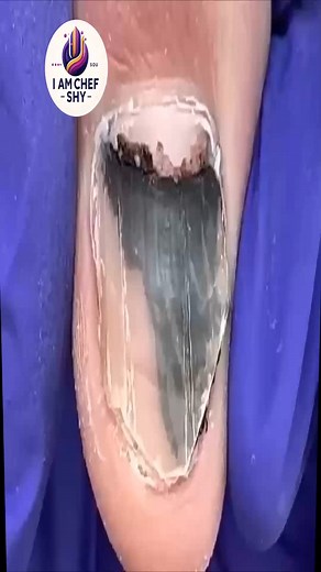 Safe Cracked-Toenail Cleaning for Better Hygiene 🍅🌹 #HealthyHabitsDaily #FootSupportGuide #EverydayCare | I am Chef Shy