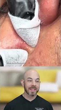 This Acne Transformation Is Just Getting Started…