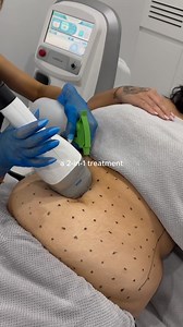 ✨ Ready to say goodbye to stubborn fat? Now’s the time! ✨ ‼️ Take advantage of our Summer Sale and enjoy ‼️ 50% OFF all treatments* ‼️ across ALL clinics! Discover LIPOcel Body Sculpting, our cutting-edge, non-surgical treatment designed to reduce fat, tighten skin, and contour your body—all with High-Intensity Focused Ultrasound (HIFU) technology. 🌟 Why Choose LIPOcel? ✔️ Precise Fat Reduction: Effectively targets problem areas. ✔️ Non-invasive: No needles, no surgery, no downtime. ✔️ Comforta