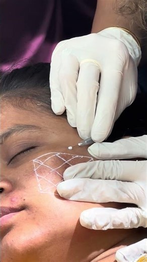 Alpha mono PDO threads for acne scar treatment non surgicals procedure by alpha surgicals