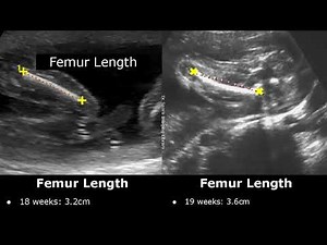 Femur Length Ultrasound Normal Values | Femoral Length Measurements | Fetal Biometric Parameters USG