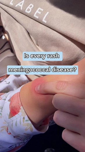 Meningococcal Disease: Misconceptions and Rash Concerns