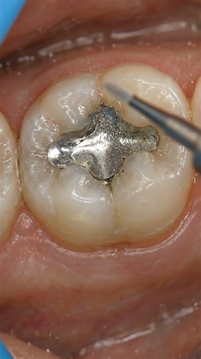 Replacing an Old Filling: Satisfying Transformation | #dentaltreatment #dentistry
