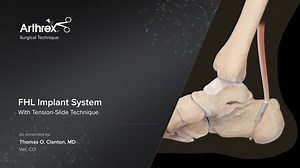 FHL Implant System With Tension-Slide Technique