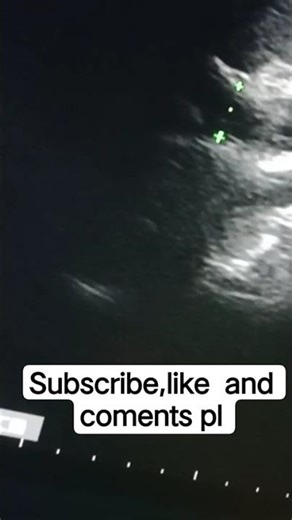 “Dilated Portal Vein + Heterogeneous Liver → Portal Hypertension”