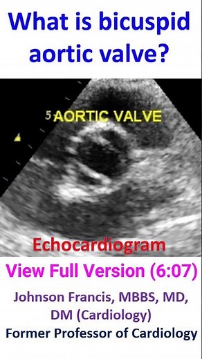 What is bicuspid aortic valve?