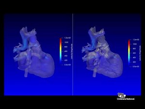 4D Flow: Advanced Imaging Measures Critical Blood Flow Characteristics of Single Ventricle Hearts