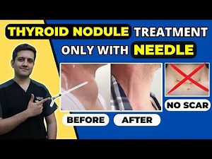 THYROID NODULE TREATMENT WITHOUT SURGERY | COLLOID GOITER TREATMENT | LIVE by Dr. Gaurav Gangwani