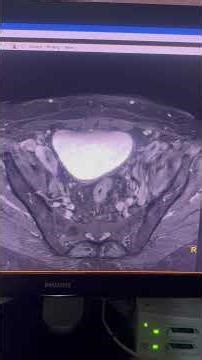 #mri # prostate with contrast #3T