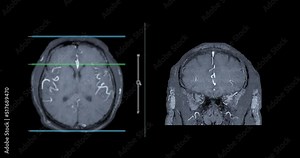 MRA Brain or Magnetic resonance angiography of the brain axial MIP view showing cerebral artery .