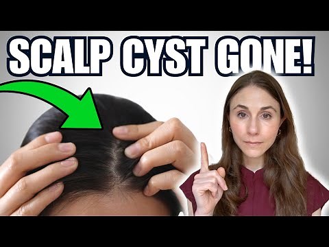 Unveiling The Truth About Pilar Cyst Causes & Treatment