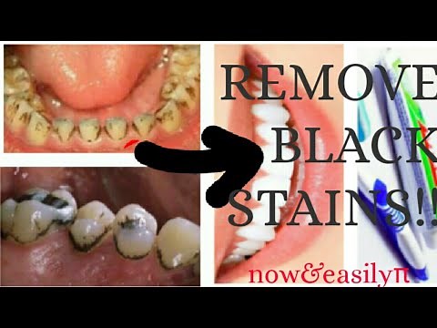 How to get white teeth, Remove black stains from your teeth easily /Just toothpaste