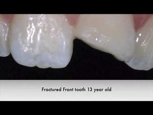 White Filling Restoration Front Tooth